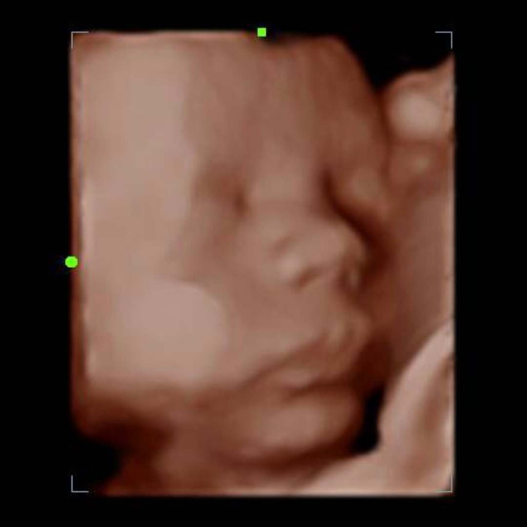 First Look Imaging – 3D/4D Ultrasounds